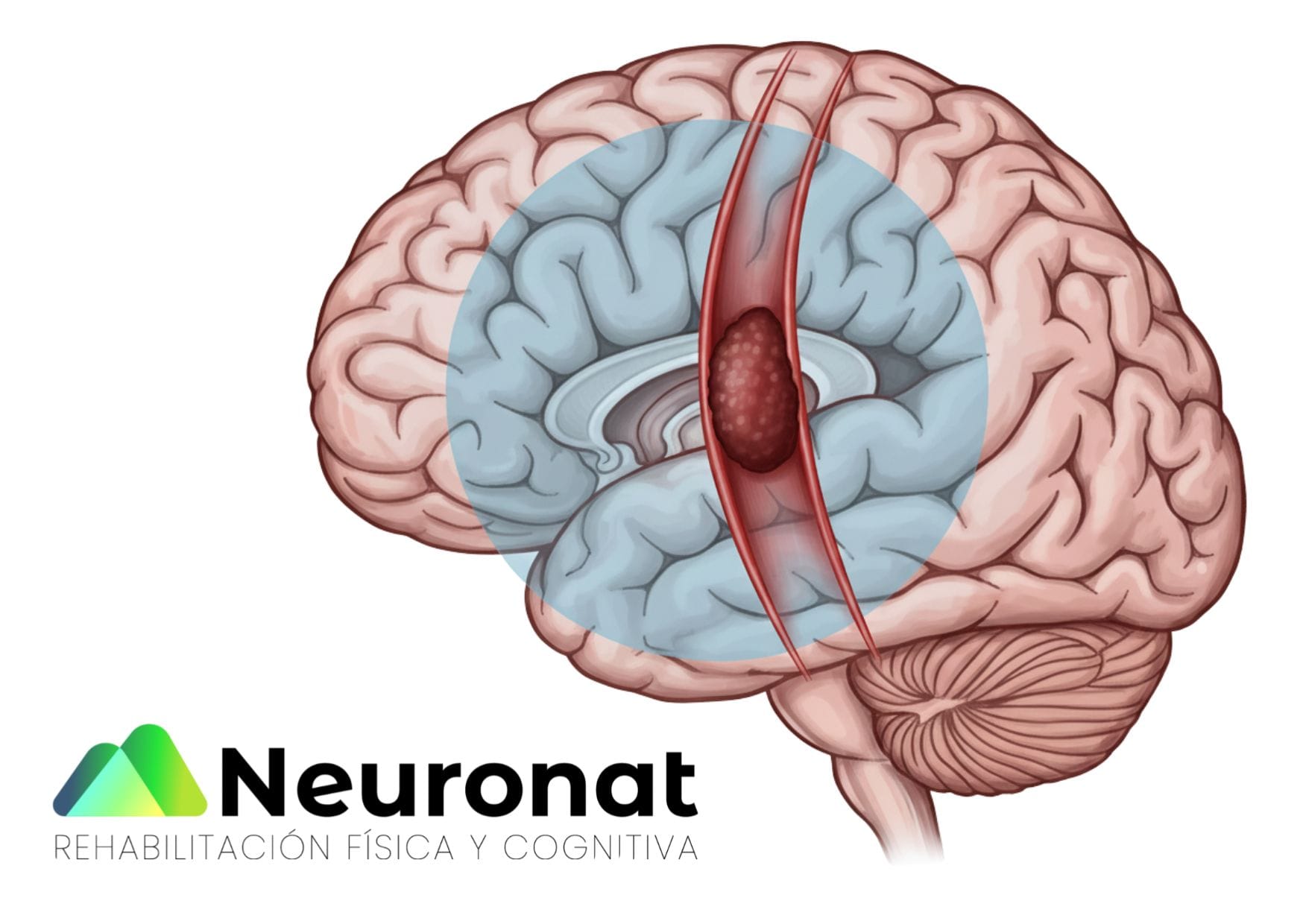 Ictus isquémico: Causas, síntomas y tratamiento - NEURONAT